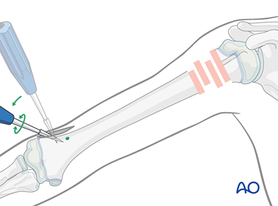 Elastic nailing for Simple complete metaphyseal fracture