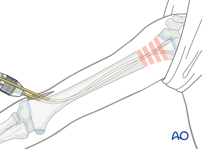 Elastic nailing for Simple complete metaphyseal fracture