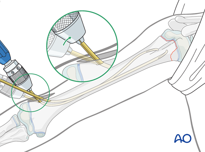 Elastic nailing for Epiphysiolysis with/without metaphyseal wedge ...