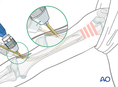Elastic nailing for Multifragmentary complete metaphyseal fracture