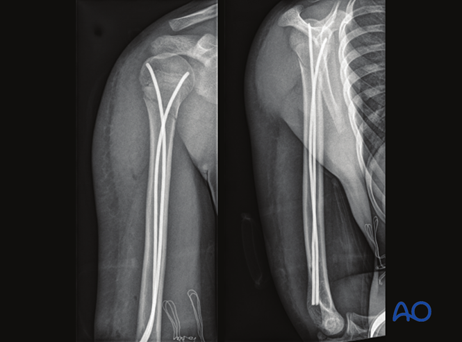 Elastic nailing for Simple complete metaphyseal fracture