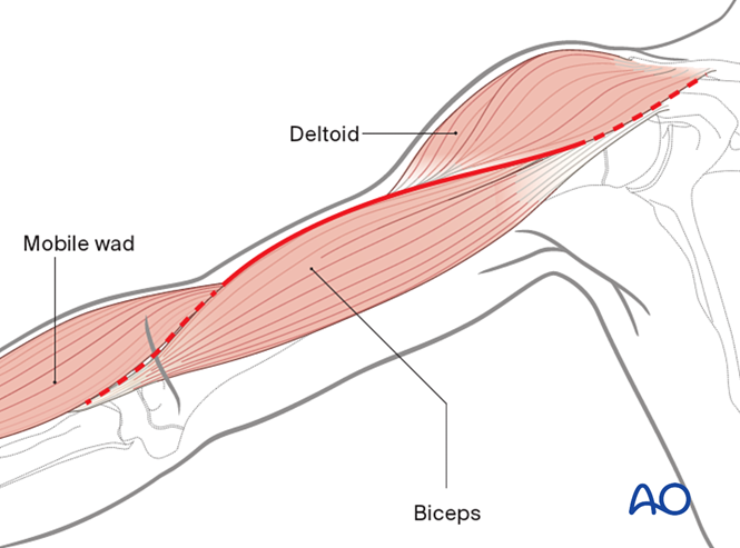 All approaches to the pediatric humeral shaft