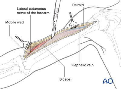 Anterolateral approach to the humeral shaft