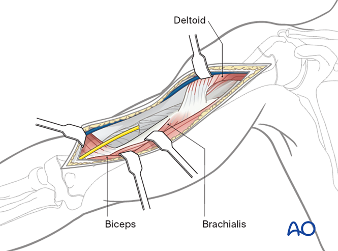 Anterolateral approach to the humeral shaft