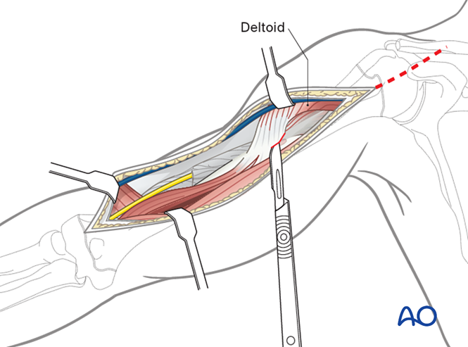 Anterolateral approach to the humeral shaft