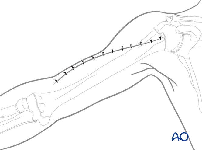 Anterolateral approach to the humeral shaft