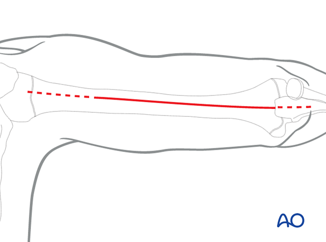 Posterior approach to the humeral shaft