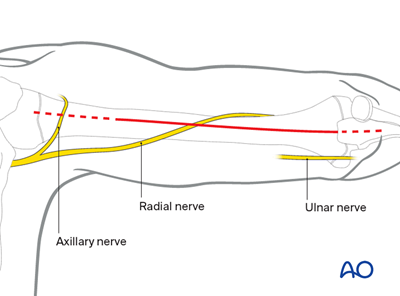 Posterior approach to the humeral shaft