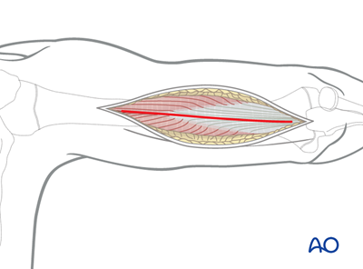 Posterior approach to the humeral shaft