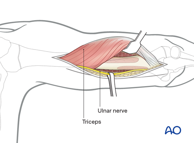 Posterior approach to the humeral shaft