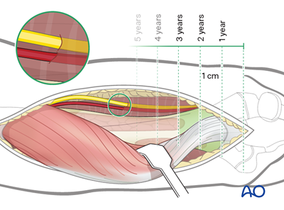 Posterior approach to the humeral shaft