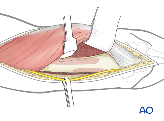 Posterior approach to the humeral shaft