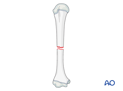 Simple complete transverse fracture