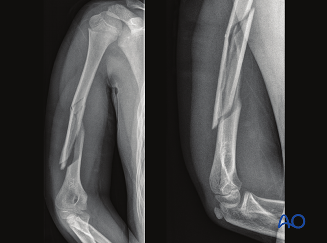 Multifragmentary complete fracture