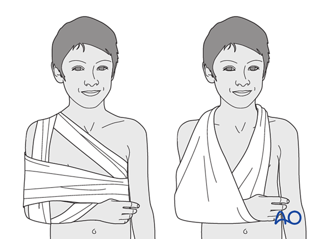 Immobilization with body binder/sling for Simple complete transverse ...