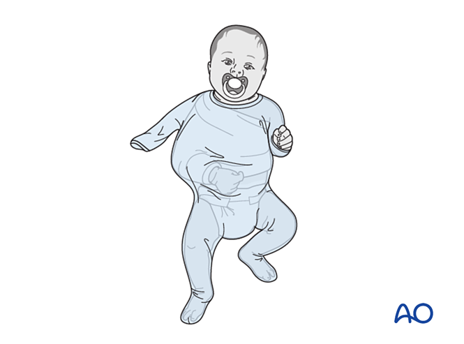 Immobilization with body binder/sling for Simple complete transverse ...