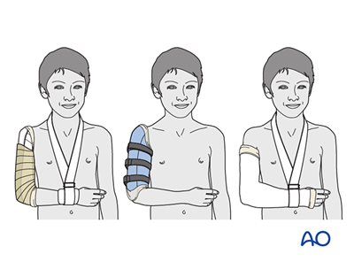 Immobilization with splint, brace, or cast for Simple complete ...