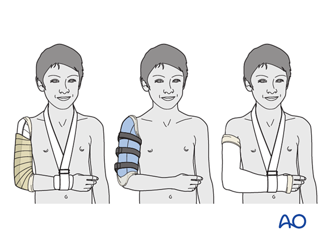 Immobilization with splint, brace, or cast for Simple complete ...