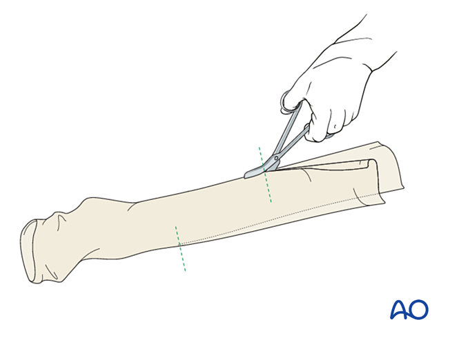 Immobilization with splint, brace, or cast for Simple complete ...