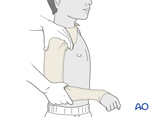 Immobilization with splint, brace, or cast for Simple complete ...