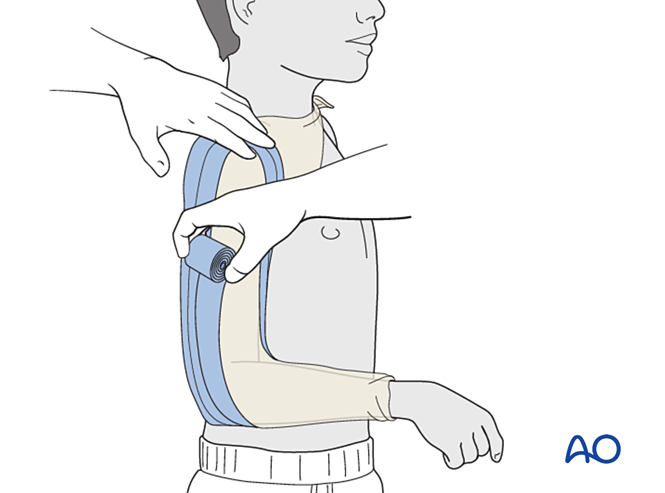 Immobilization with splint, brace, or cast for Multifragmentary ...