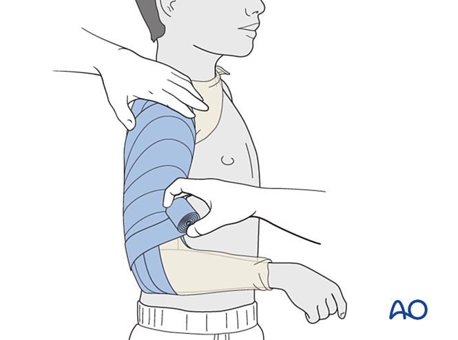 Immobilization with splint, brace, or cast for Simple complete ...