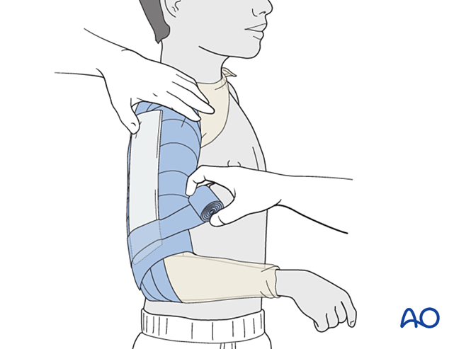 Immobilization with splint, brace, or cast for Multifragmentary ...