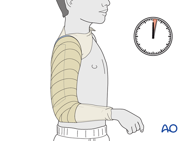 Immobilization with splint, brace, or cast for Simple complete ...