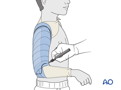 Immobilization with splint, brace, or cast for Simple complete oblique ...
