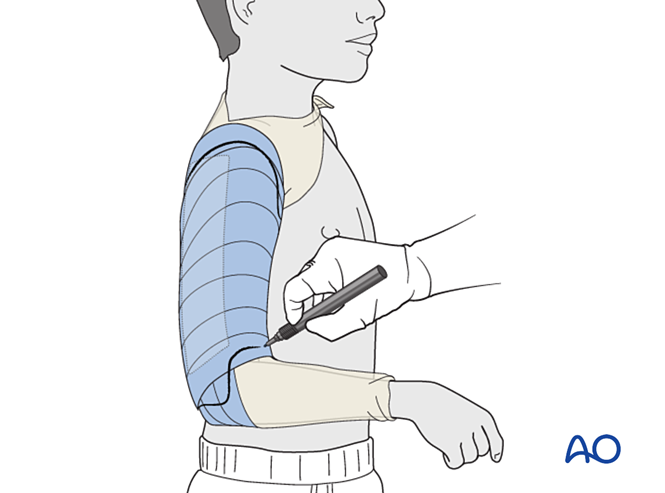 Immobilization with splint, brace, or cast for Multifragmentary ...