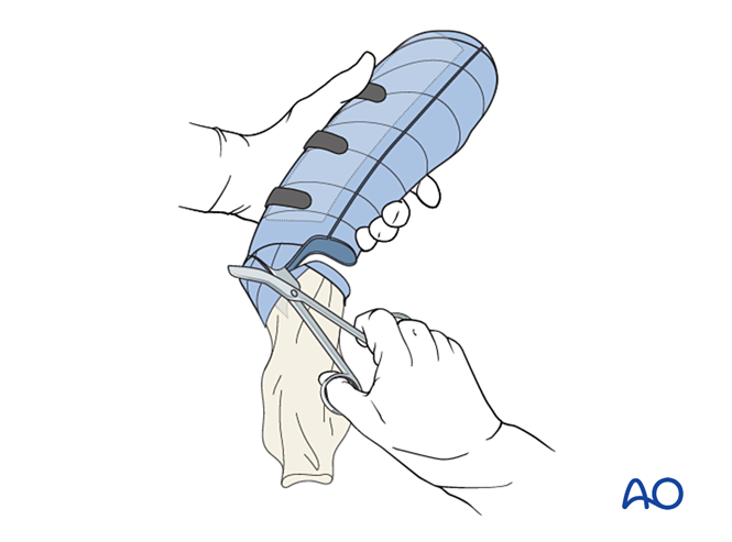 Immobilization with splint, brace, or cast for Simple complete ...