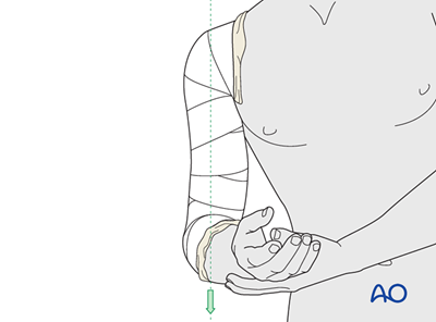 Immobilization with splint, brace, or cast for Simple complete ...