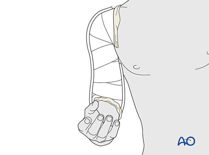 Immobilization with splint, brace, or cast for Simple complete ...