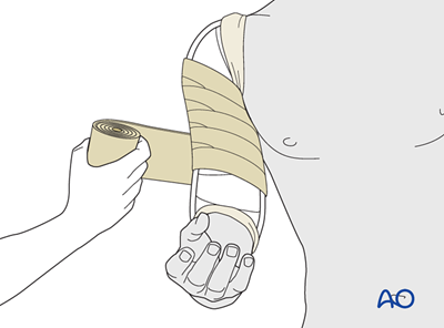 Immobilization with splint, brace, or cast for Simple complete oblique ...