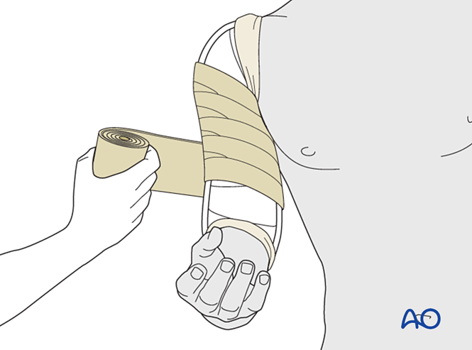 Immobilization with splint, brace, or cast for Simple complete ...