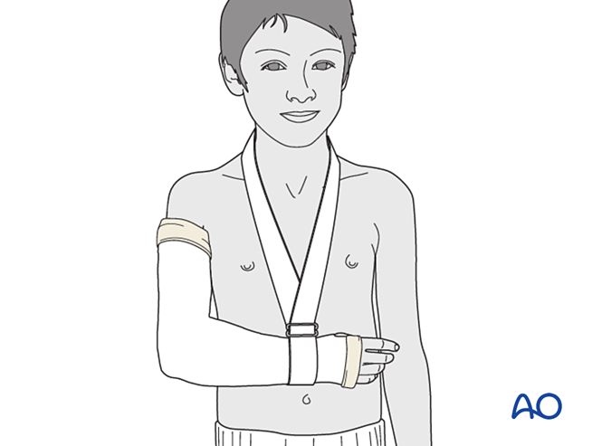 Immobilization with splint, brace, or cast for Simple complete ...