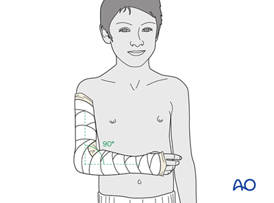 Immobilization with splint, brace, or cast for Simple complete ...