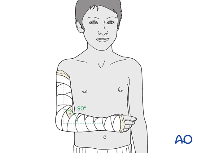 Immobilization with splint, brace, or cast for Simple complete ...
