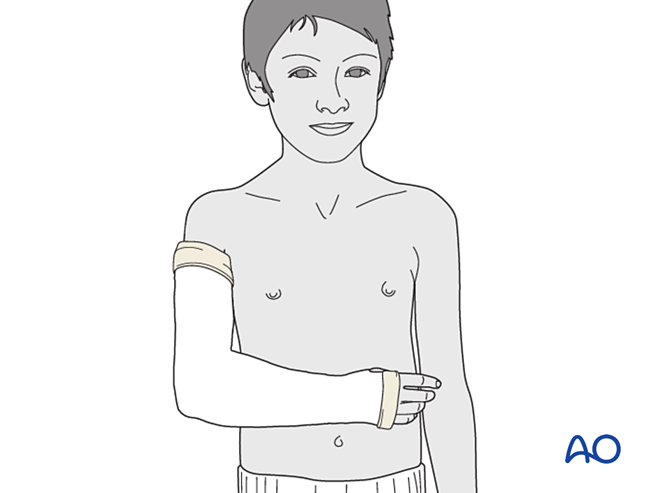 Immobilization with splint, brace, or cast for Simple complete ...