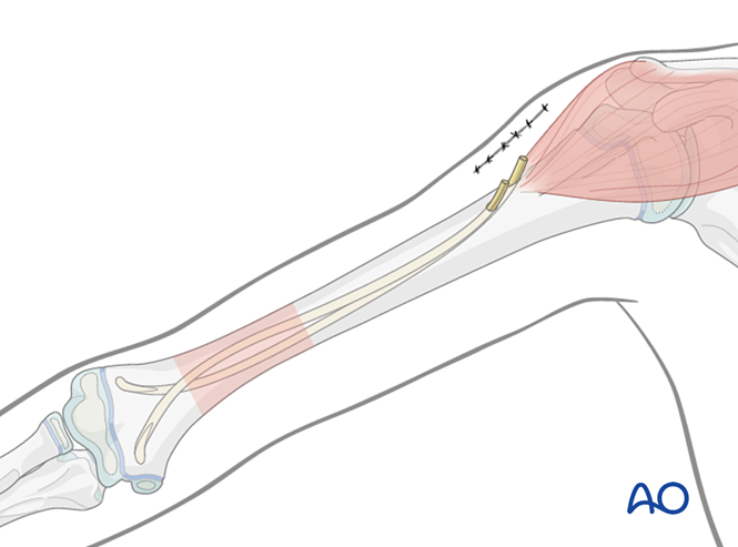 Antegrade elastic nailing (lateral insertion) for Simple complete ...