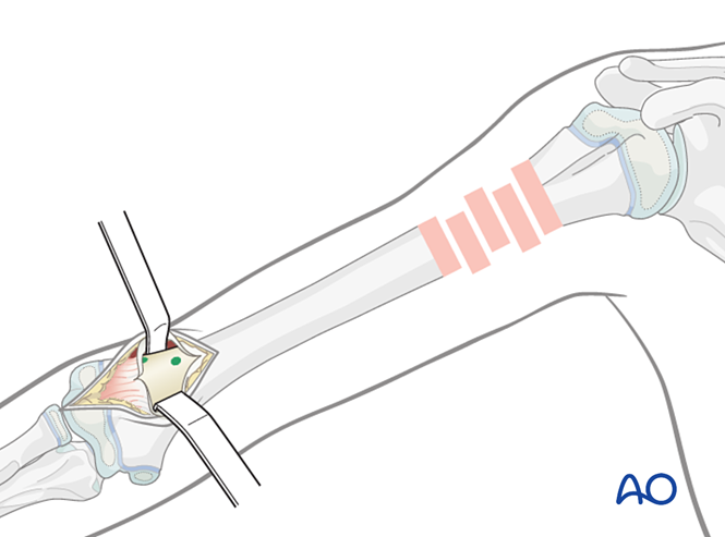 Retrograde elastic nailing (lateral insertion) for Simple complete ...