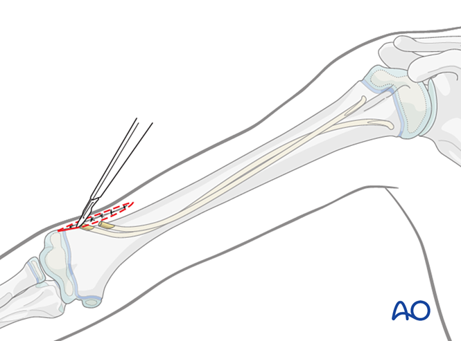 Retrograde elastic nailing (lateral insertion) for Simple complete ...