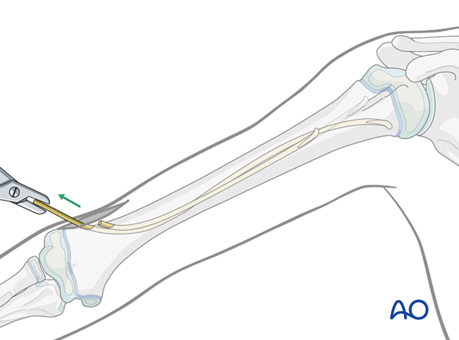 Retrograde elastic nailing (lateral insertion) for Simple complete ...
