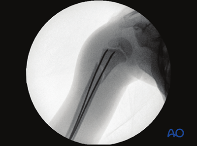 Retrograde elastic nailing (lateral insertion) for Simple complete ...