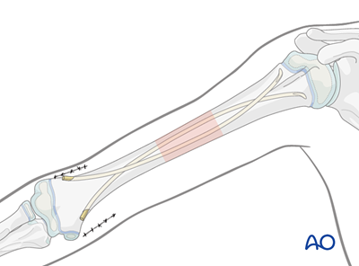 Retrograde elastic nailing (lateral and medial insertion) for Simple ...