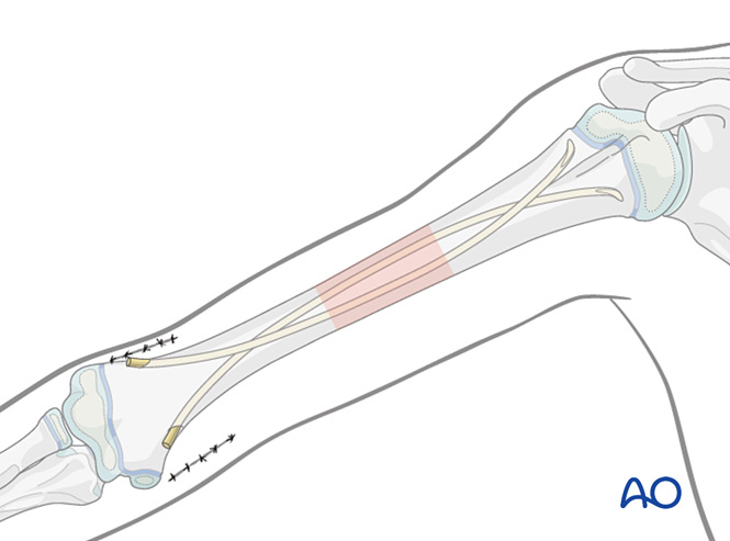 Retrograde elastic nailing (lateral and medial insertion) for Simple complete transverse fracture