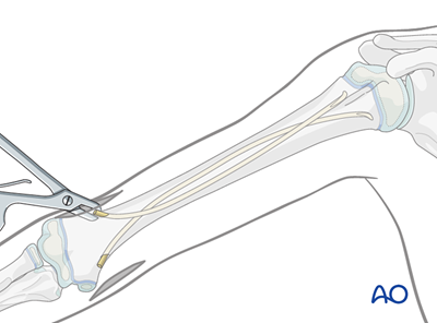 Retrograde elastic nailing (lateral and medial insertion) for Simple ...