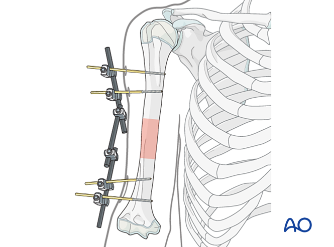 External fixation for Simple complete oblique or spiral fracture