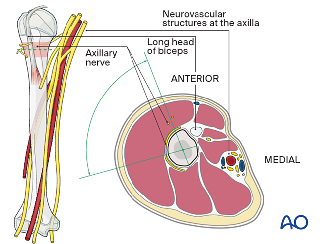 External fixation for Simple complete oblique or spiral fracture