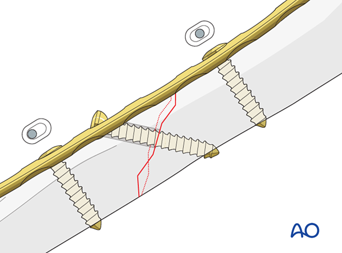 Open reduction - Compression plating for Simple complete oblique or ...